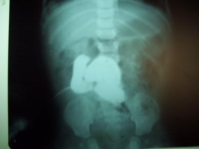 Prolapse of bowel via patent vitello intestinal duct—a rare occurrence ...