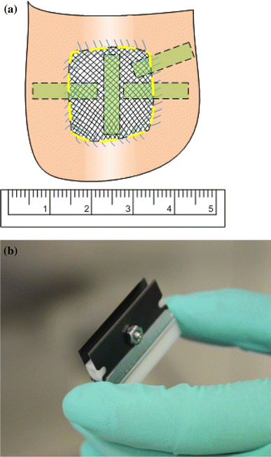 Comparison of Permacol™ and Strattice™ for the repair of abdominal wall ...