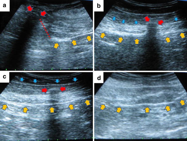 New mesh shape and improved implantation procedure to simplify and ...