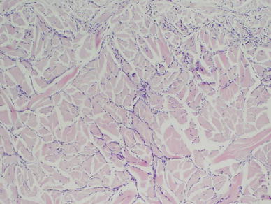 Evaluation of crosslinked and non-crosslinked biologic prostheses for ...