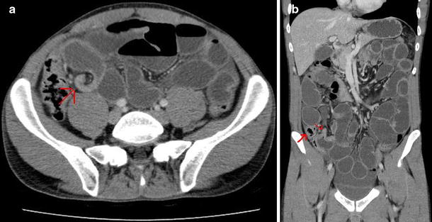 Internal hernias: a brief review | SpringerLink