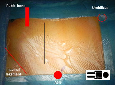 Surgical treatment of chronic pain after inguinal hernia repair ...