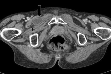Obturator hernia: the relationship between anatomical classification ...