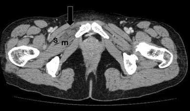 Obturator hernia: the relationship between anatomical classification ...