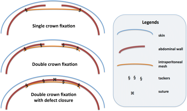 Randomized clinical trial of mesh fixation with “double crown” versus “sutures and tackers” in ...