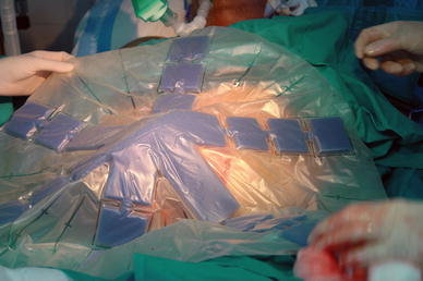 Comparative study of open abdomen treatment: ABThera™ vs. abdominal ...