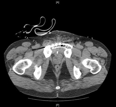 Reconstruction of the symphysis pubis to repair a complex midline ...
