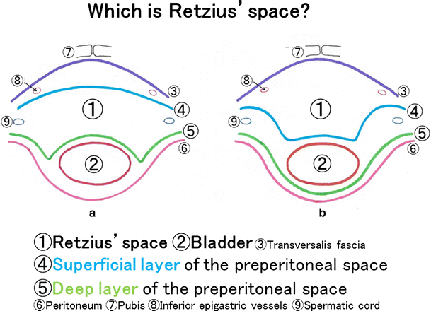 Paradigm shift regarding the transversalis fascia, preperitoneal space, and Retzius’ space ...