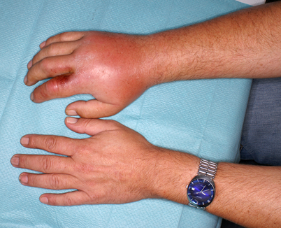 Hochdruckinjektionsverletzung der Hand | SpringerLink