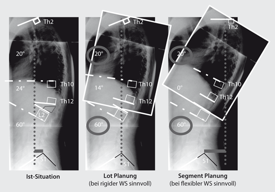 Posttraumatische thorakolumbale Kyphose | SpringerLink