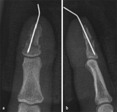 Indikationen für Kirschner-Drähte nach Frakturen an der Hand | SpringerLink