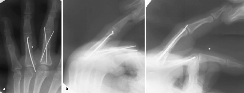 Indikationen für Kirschner-Drähte nach Frakturen an der Hand | SpringerLink