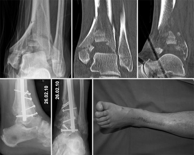 Pilon-tibiale-Frakturen | SpringerLink