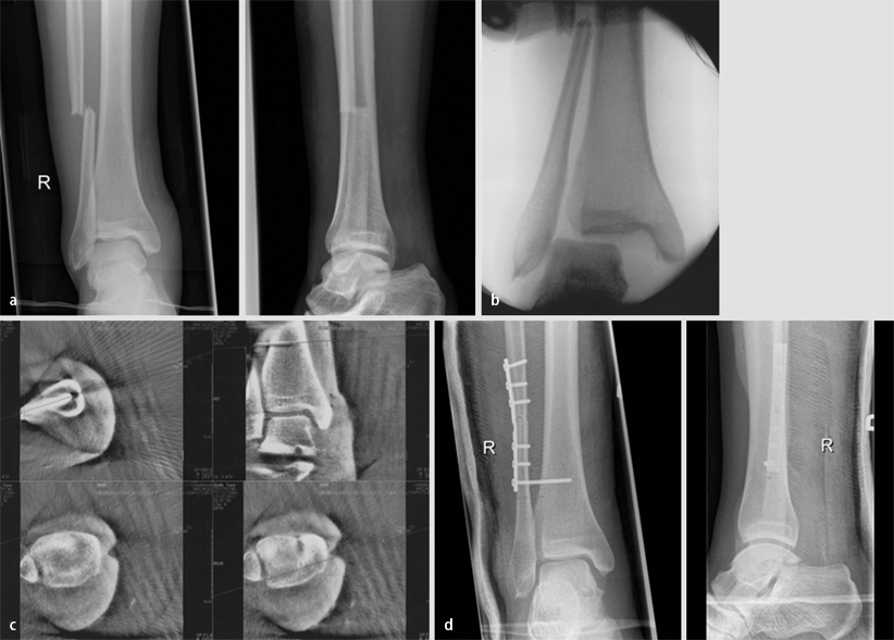 Osteosynthese von Frakturen des oberen Sprunggelenks | SpringerLink