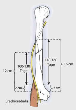 N.-radialis-Ausfälle im Oberarmbereich | SpringerLink