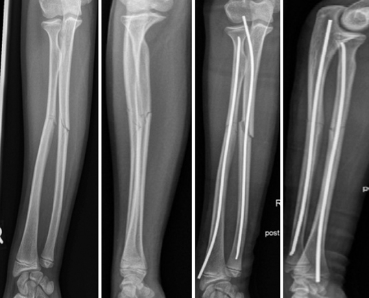 Elastisch stabile intramedulläre Nagelung | SpringerLink