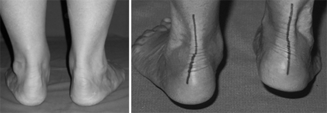 Sehnenverletzungen erkennen und richtig behandeln | SpringerLink
