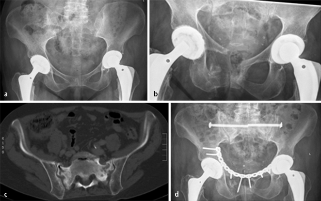 Insuffizienzfrakturen des Beckenrings | SpringerLink