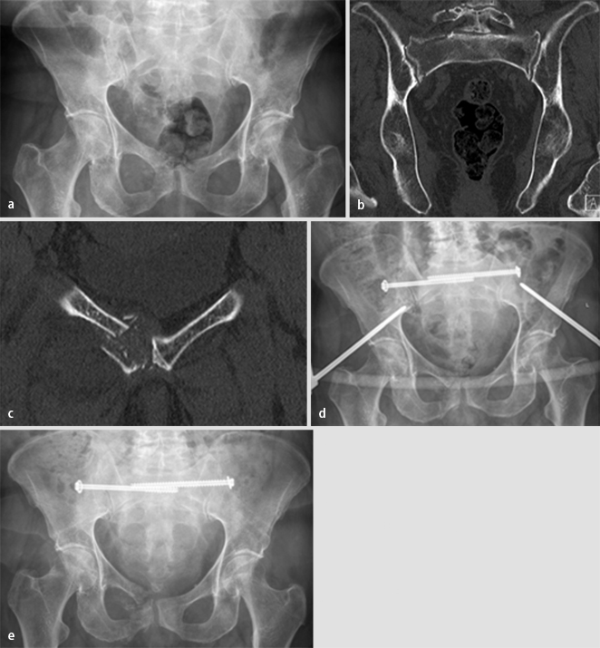 Insuffizienzfrakturen des Beckenrings | SpringerLink