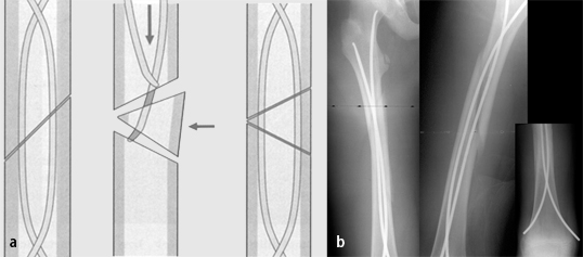 Was tun, wenn die elastisch-stabile intramedulläre Nagelung (ESIN) an ihre Grenzen stößt ...