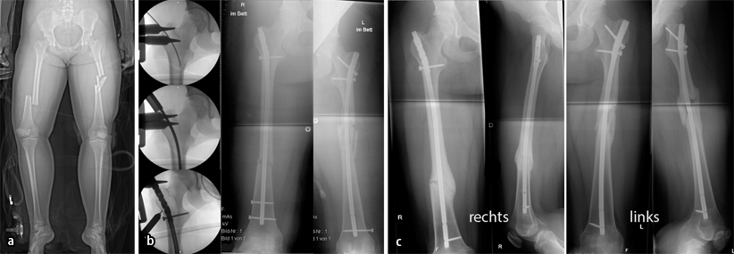 Was tun, wenn die elastisch-stabile intramedulläre Nagelung (ESIN) an ihre Grenzen stößt ...