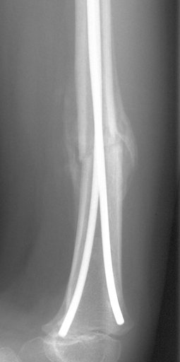 Was tun, wenn die elastisch-stabile intramedulläre Nagelung (ESIN) an ihre Grenzen stößt ...