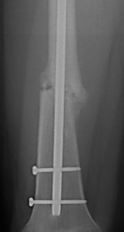 Was tun, wenn die elastisch-stabile intramedulläre Nagelung (ESIN) an ihre Grenzen stößt ...