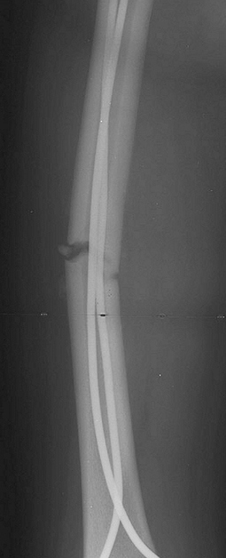 Was tun, wenn die elastisch-stabile intramedulläre Nagelung (ESIN) an ihre Grenzen stößt ...