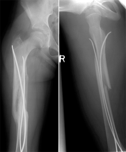 Was tun, wenn die elastisch-stabile intramedulläre Nagelung (ESIN) an ihre Grenzen stößt ...