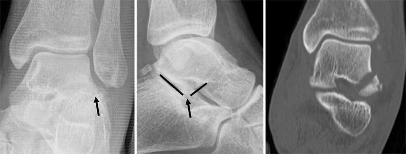 Therapiestrategien bei Talusfrakturen | SpringerLink