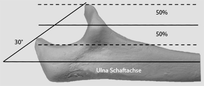 Knochenaufbauplastiken am Processus coronoideus ulnae | SpringerLink
