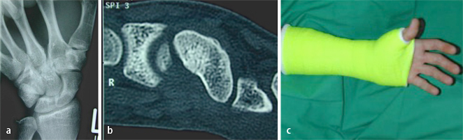 Knöcherne Verletzungen der Handwurzel | SpringerLink