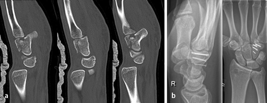 Knöcherne Verletzungen der Handwurzel | SpringerLink