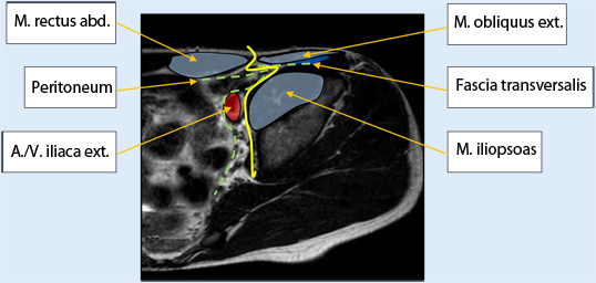 Der pararektale Zugang | SpringerLink