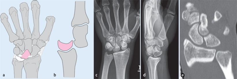 Perilunäre Luxationen und Luxationsfrakturen an der Handwurzel ...