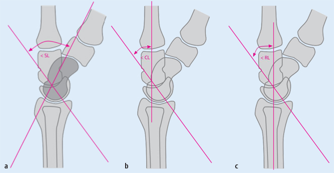 Perilunäre Luxationen und Luxationsfrakturen an der Handwurzel ...