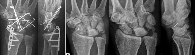 Perilunäre Luxationen und Luxationsfrakturen an der Handwurzel ...