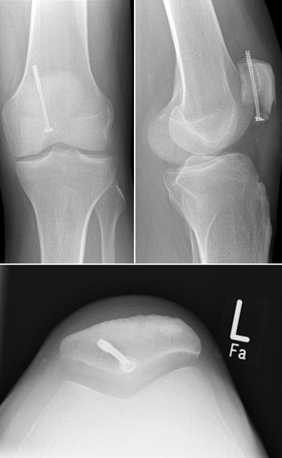 Patellafrakturen | SpringerLink