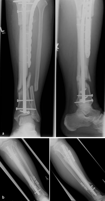 Knochenaugmentation bei hypo- und atrophen Pseudarthrosen | SpringerLink