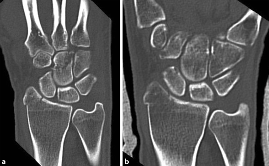 Frische Frakturen der Handwurzel | SpringerLink