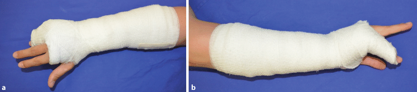 Gipstechniken in der Handchirurgie | SpringerLink