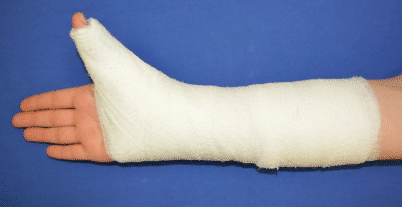 Gipstechniken in der Handchirurgie | SpringerLink