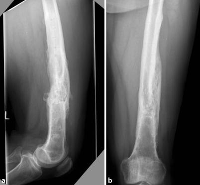 Nanostrukturiertes synthetisches Knochenersatzmaterial zur Behandlung ...