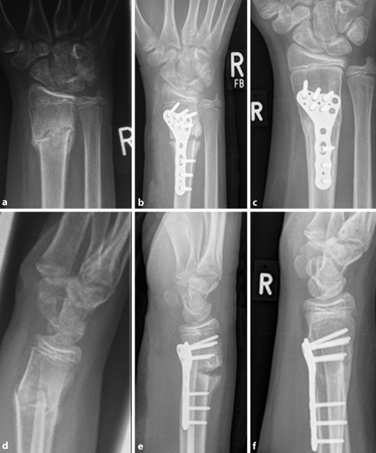 Operative Möglichkeiten zur Behandlung von fehlverheilten distalen ...