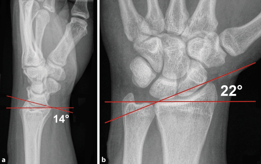 Distale Radiusfraktur | SpringerLink