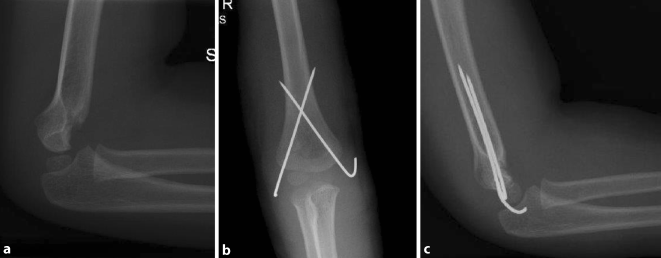 Gelenknahe Fraktur | SpringerLink