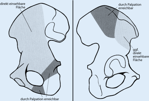 Acetabulumfrakturen | SpringerLink