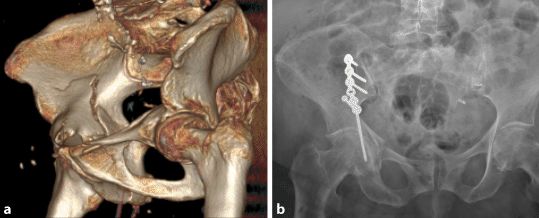 Acetabulumfrakturen | SpringerLink
