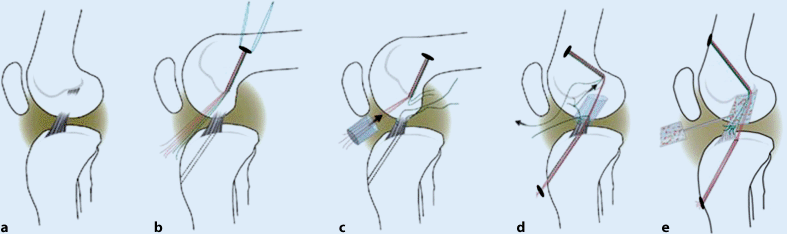 Update vordere Kreuzbandruptur | SpringerLink