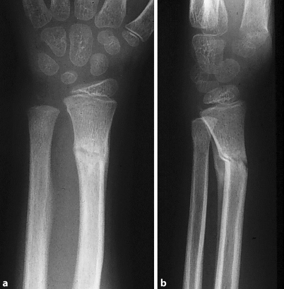 Behandlung der kindlichen Unterarmschaftfraktur | SpringerLink